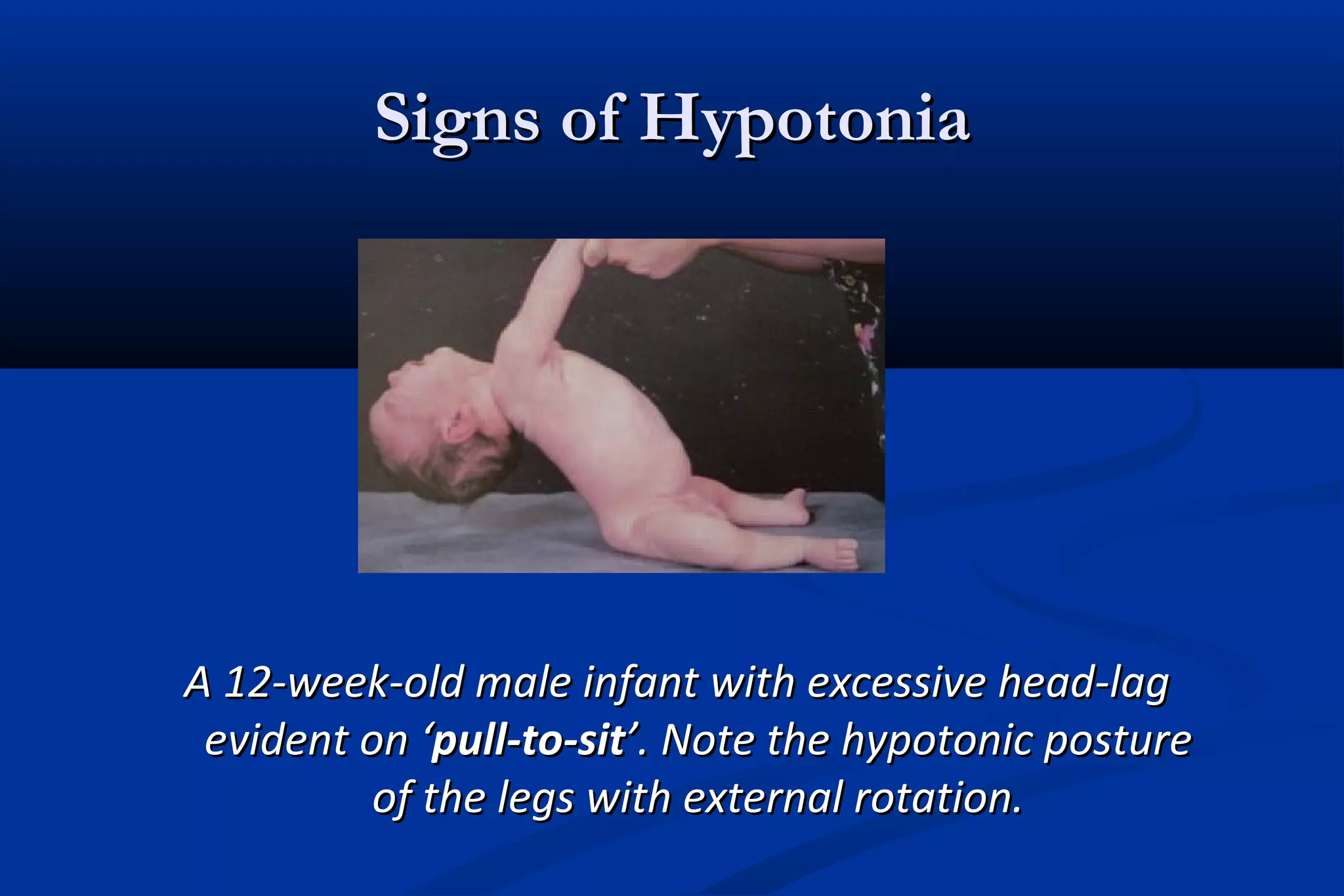 Hypotonia in children | PPT