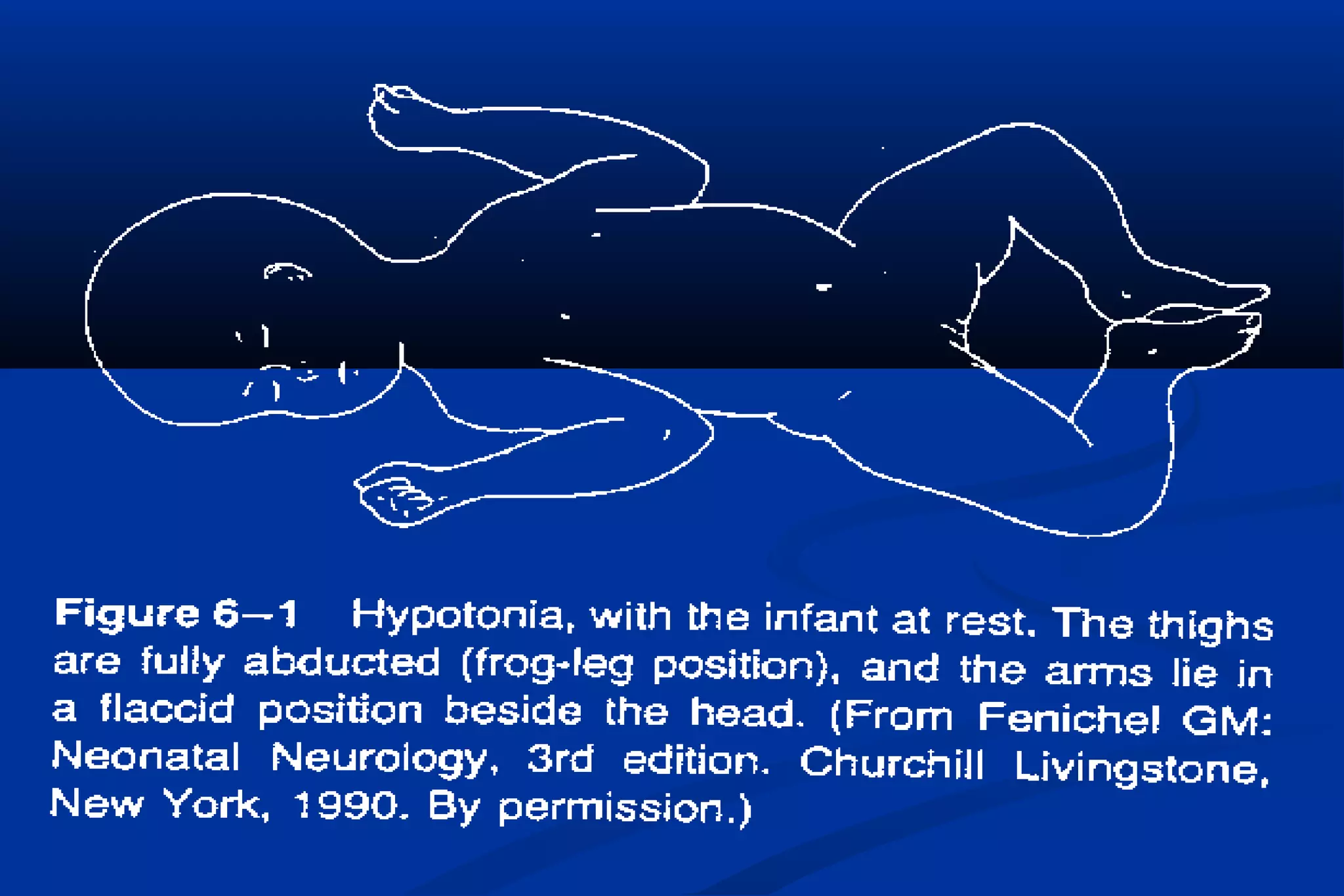 Hypotonia in children | PPT