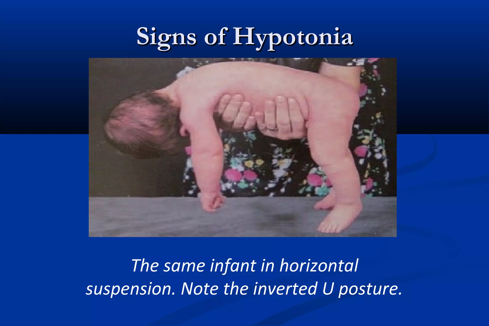Hypotonia in children | PPT