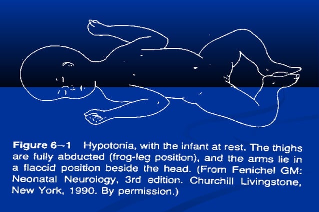 Hypotonia in children | PPT | Pregnancy | Reproductive Health