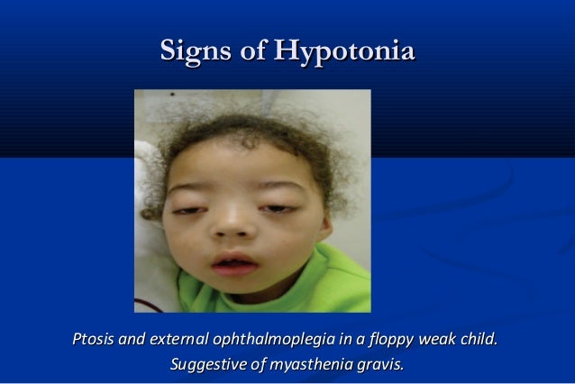 Hypotonia in children