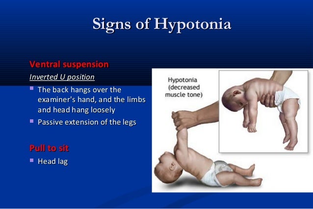 Hypotonia in children