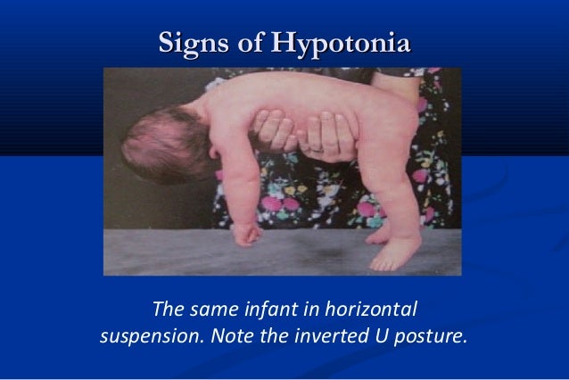 Hypotonia in children