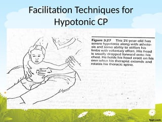 Types of cerebral palsy (Hypotonic type) for physiotherapist | PPTX