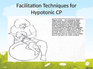 Types of cerebral palsy (Hypotonic type) for physiotherapist | PPTX