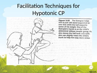 Types of cerebral palsy (Hypotonic type) for physiotherapist | PPTX