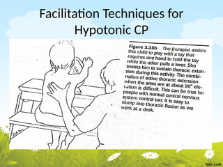 Types of cerebral palsy (Hypotonic type) for physiotherapist | PPTX