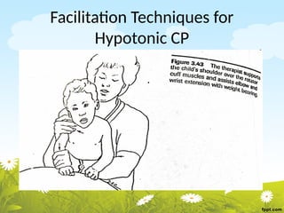 Types of cerebral palsy (Hypotonic type) for physiotherapist | PPTX