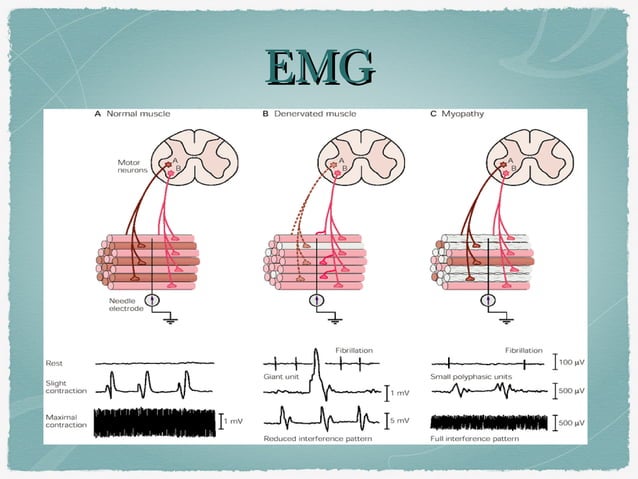 Hypotonic infant | PPT