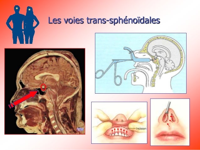 La chirurgie hypophysaire par voie trans nasale endoscopique