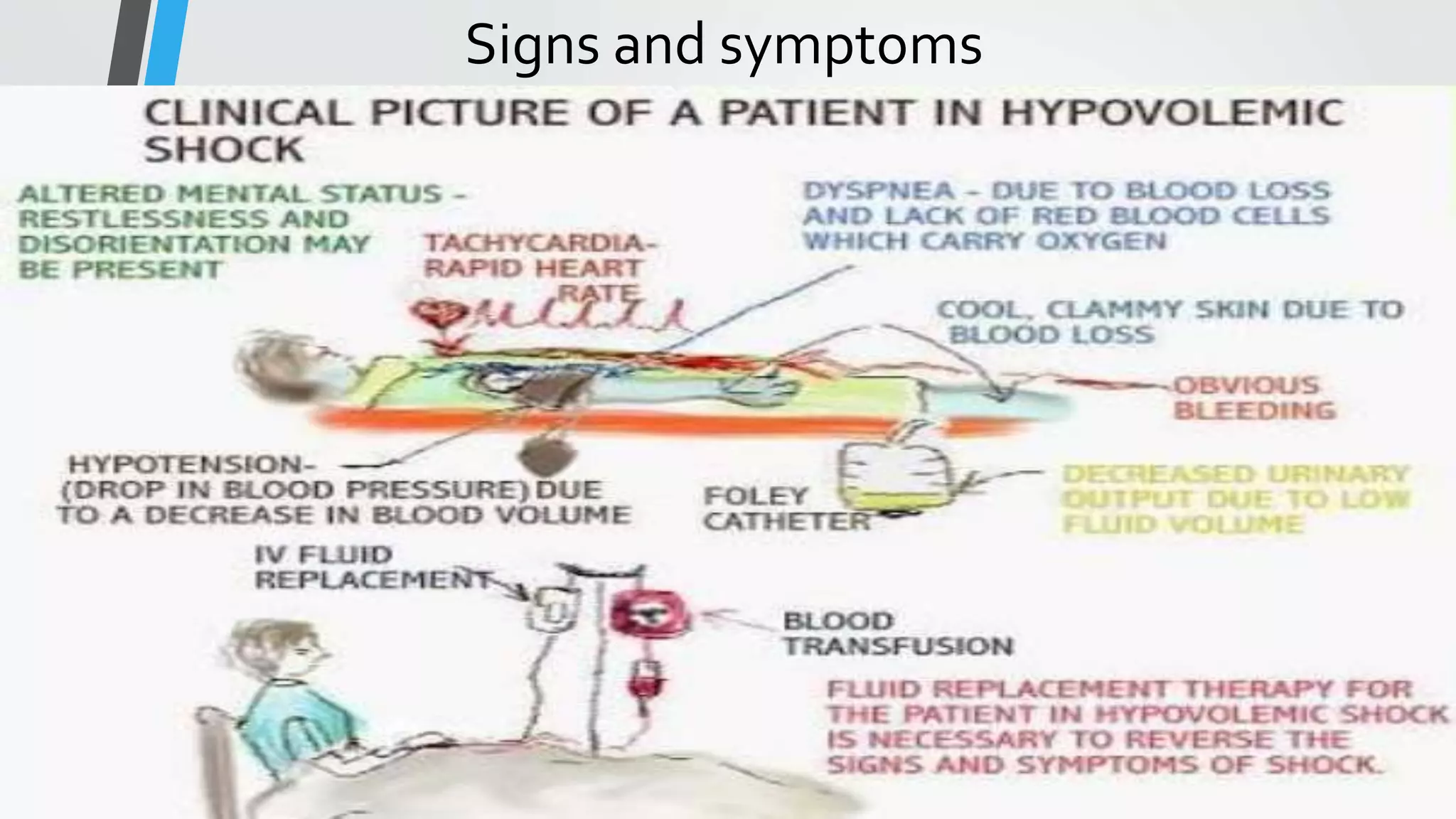 Hypovolemic shock | PPTX