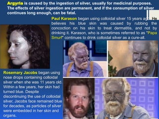 Argyria Paul Karason