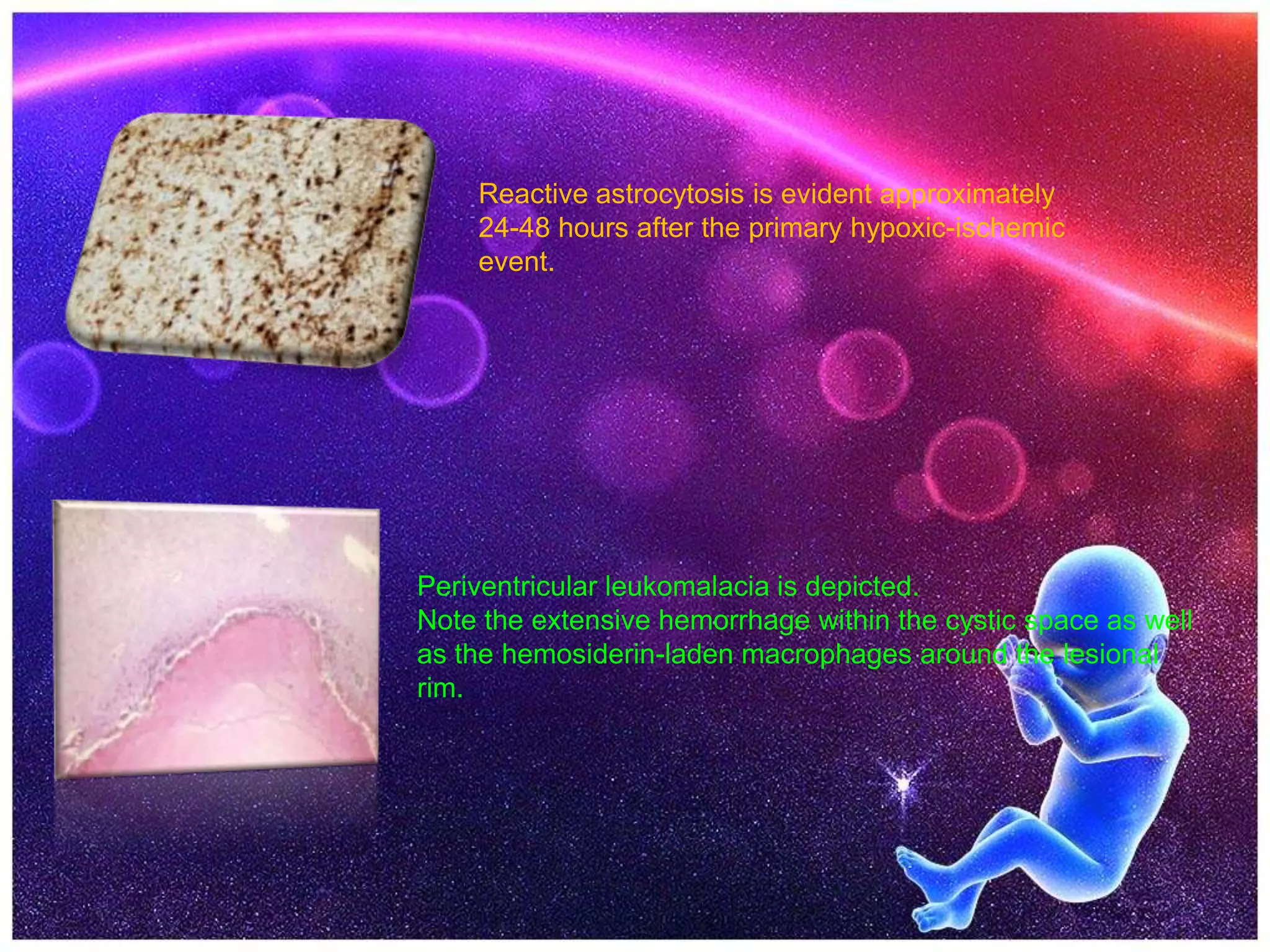 hypoxicischaemicencephalopathy-120430100906-phpapp02.pdf