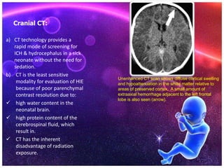 hypoxicischaemicencephalopathy-120430100906-phpapp02.pdf