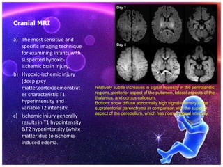 hypoxicischaemicencephalopathy-120430100906-phpapp02.pdf
