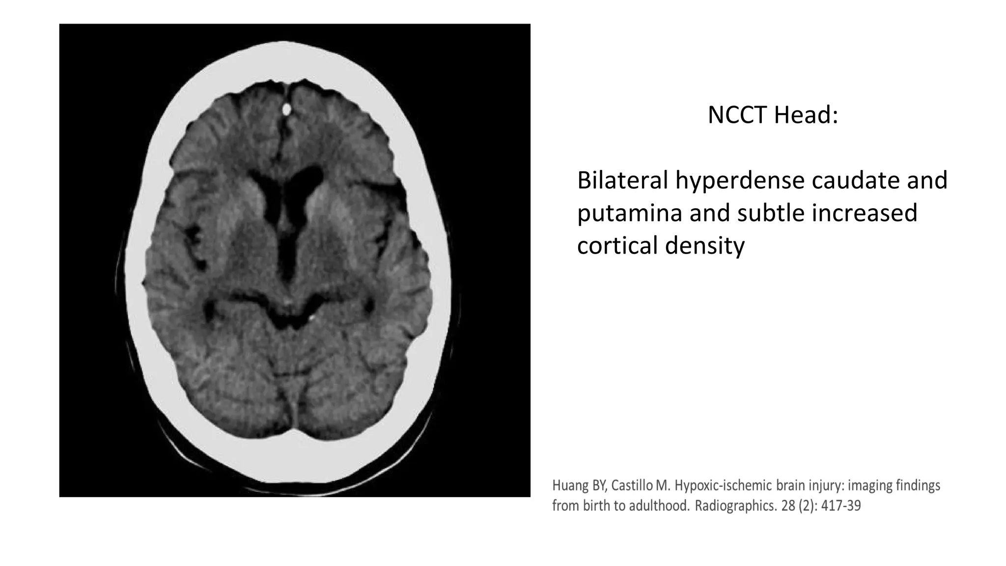 Hypoxic ischemic encephalopathy | PPT