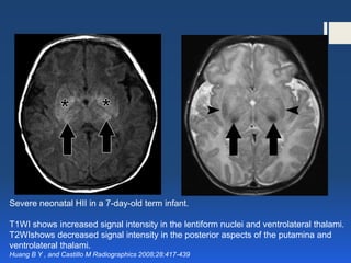 Hypoxic Ct Scan