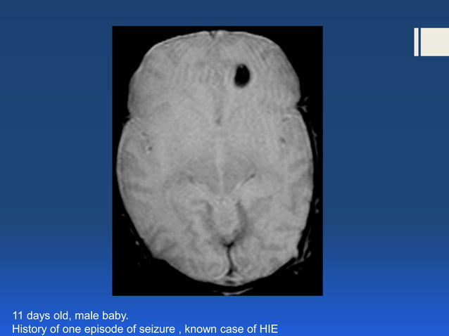 Hypoxic Ischemic Encephalopathy Ppt