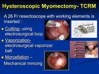 Hysteroscopic Myomectomy