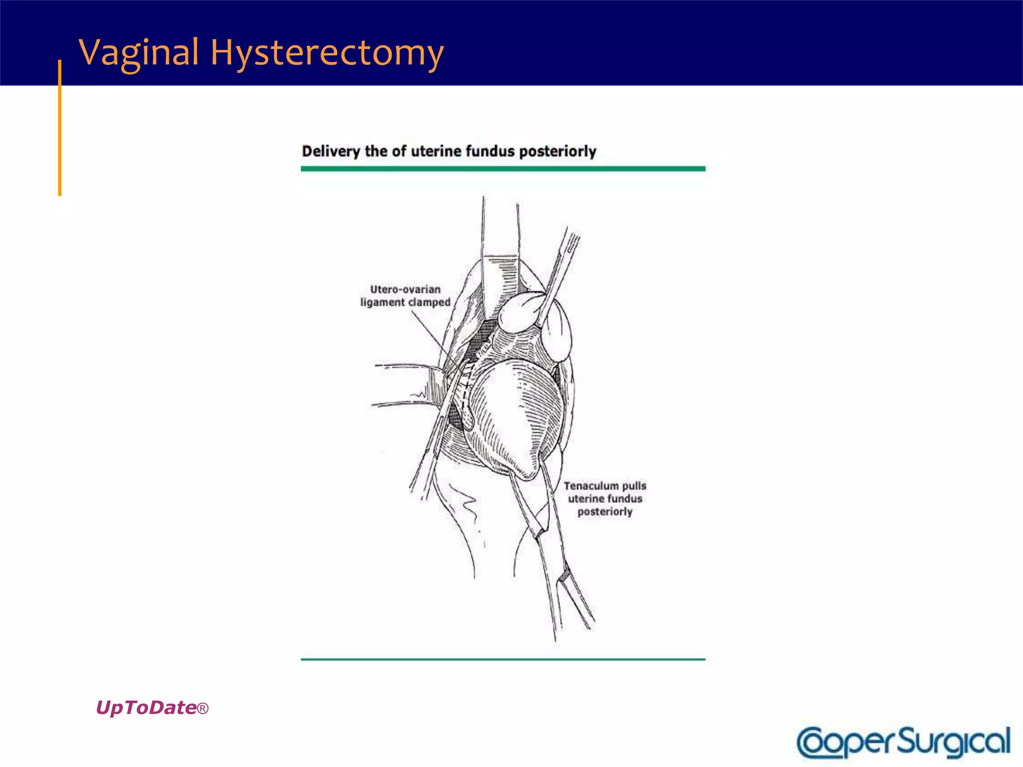 Hysterectomy.PPT