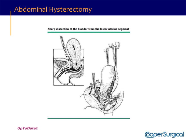 Hysterectomy.PPT