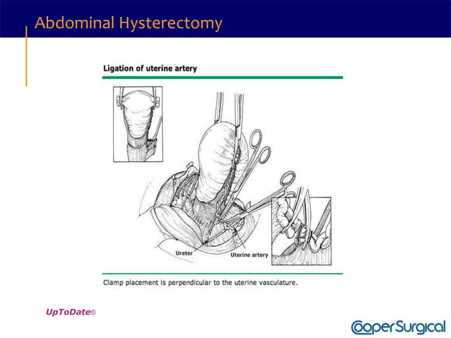 Hysterectomy.PPT
