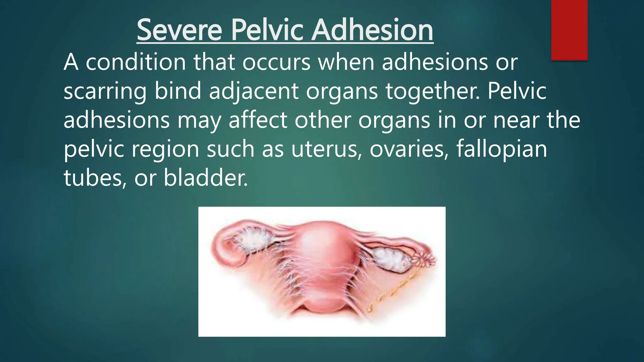 HYSTERECTOMY (Surgery and Post Surgical Physiotherapy management) | PPTX