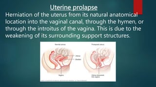 HYSTERECTOMY (Surgery and Post Surgical Physiotherapy management) | PPTX
