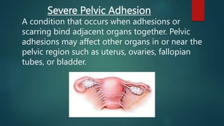 HYSTERECTOMY (Surgery and Post Surgical Physiotherapy management) | PPTX