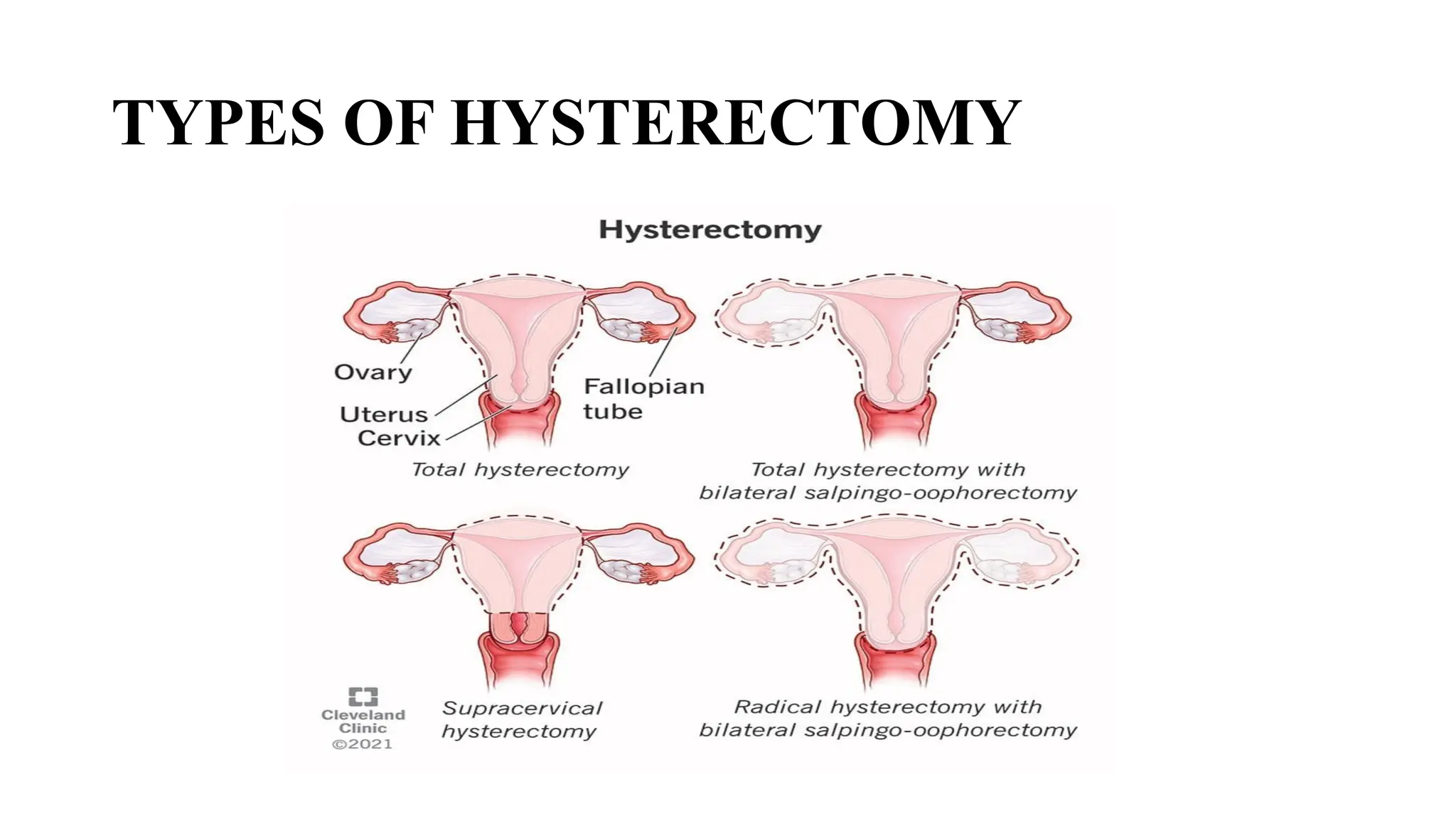 HYSTERECTOMY and it's types, indications and contraindications. | PPTX
