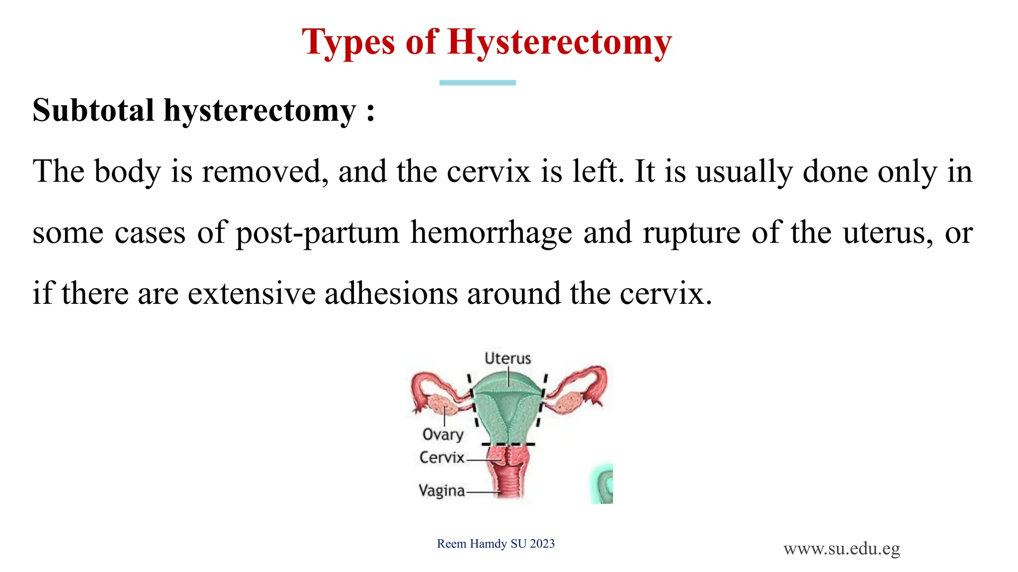 Hysterectomy 2023.pdf