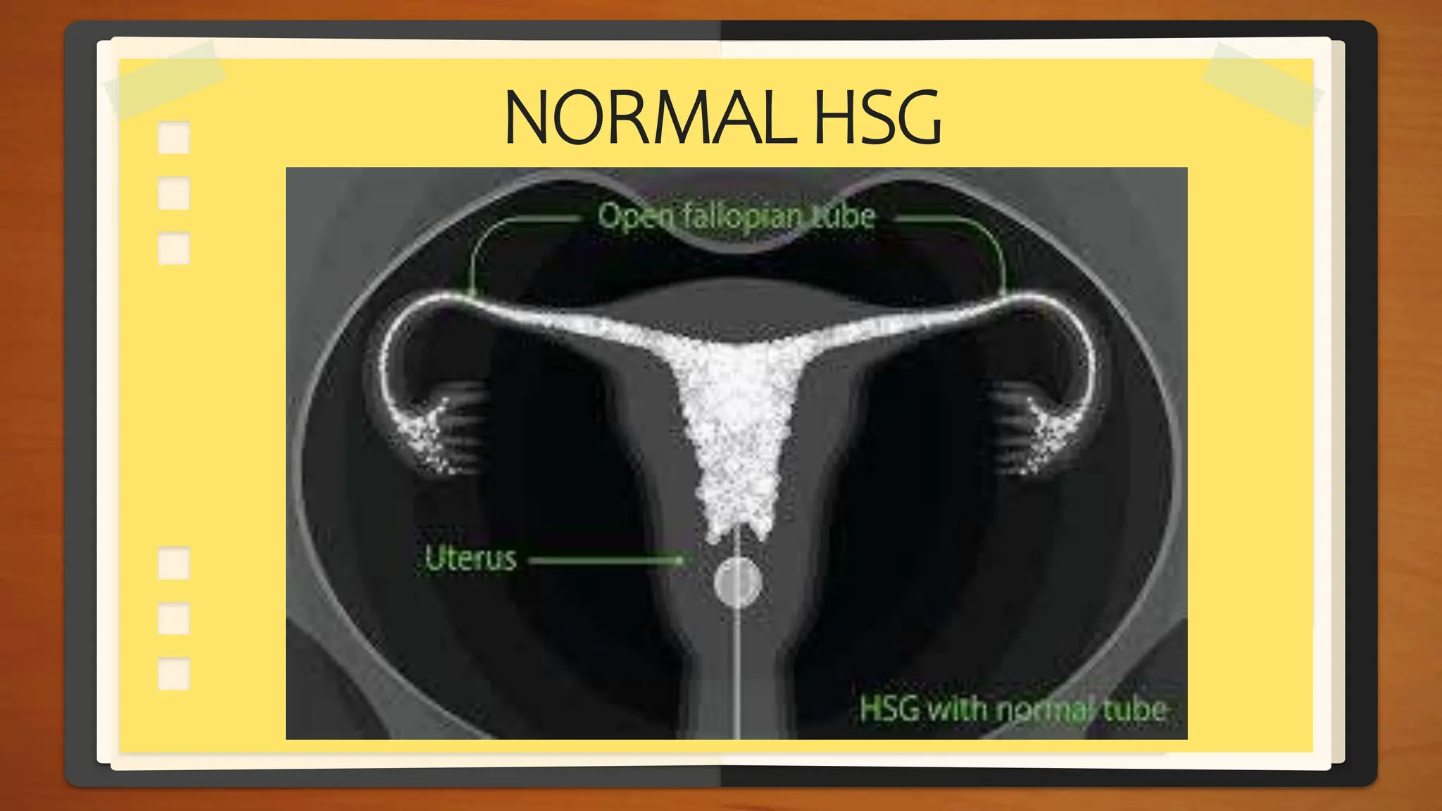 HYSTEROSALPHINGOGRAPHY - Radiology :1st Year Anatomy. | PPTX