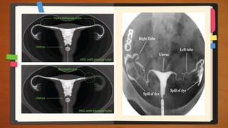 HYSTEROSALPHINGOGRAPHY - Radiology :1st Year Anatomy. | PPTX