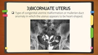 HYSTEROSALPHINGOGRAPHY - Radiology :1st Year Anatomy. | PPTX