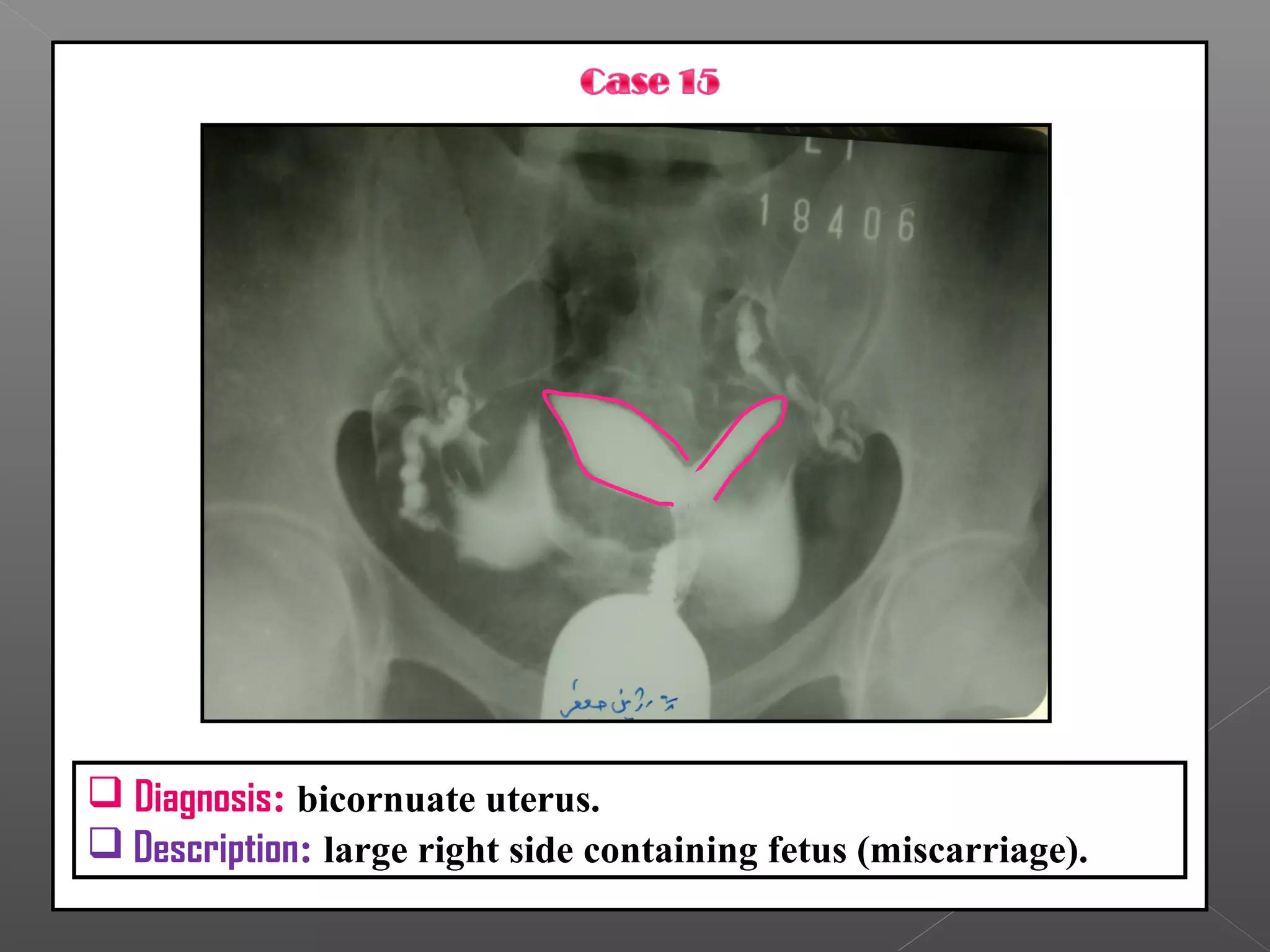 Hysterosalpingography | PPT