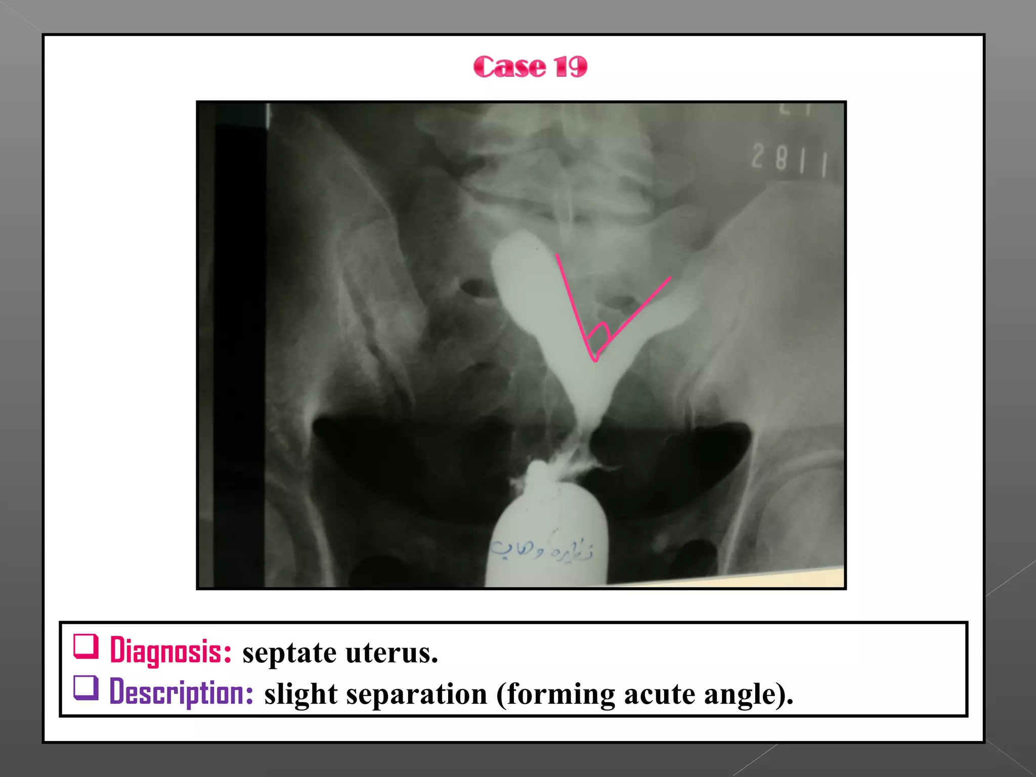 Hysterosalpingography | PPT