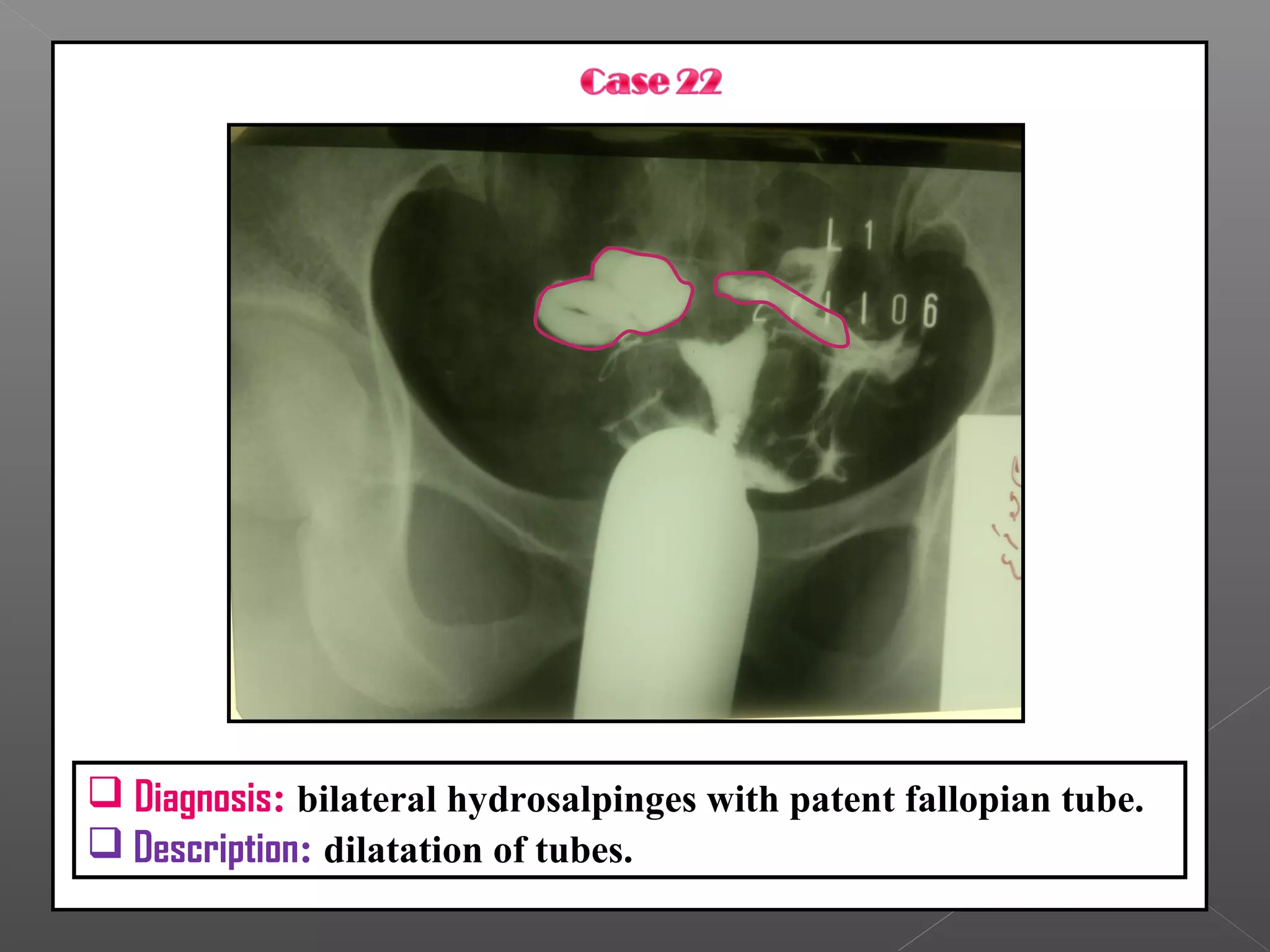 Hysterosalpingography | PPT