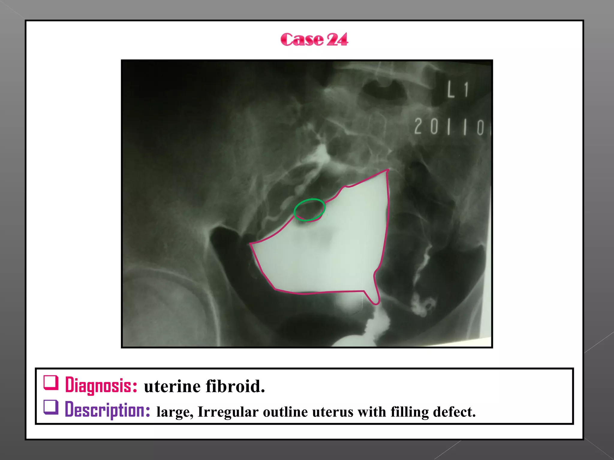 Hysterosalpingography | PPT