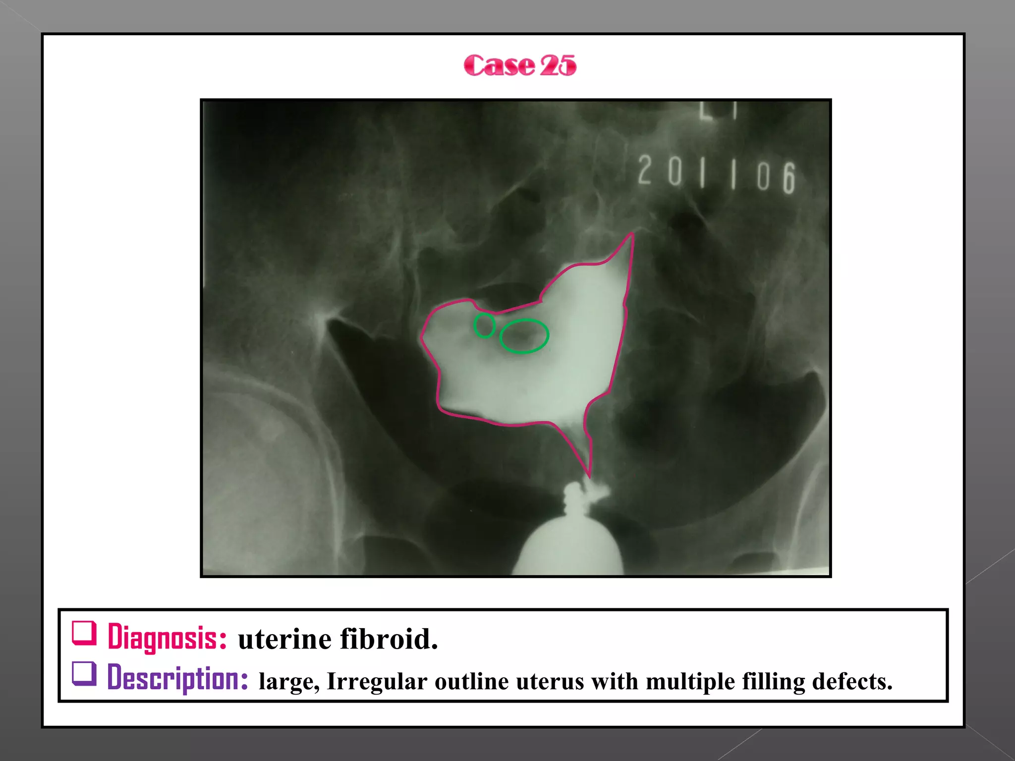 Hysterosalpingography | PPT