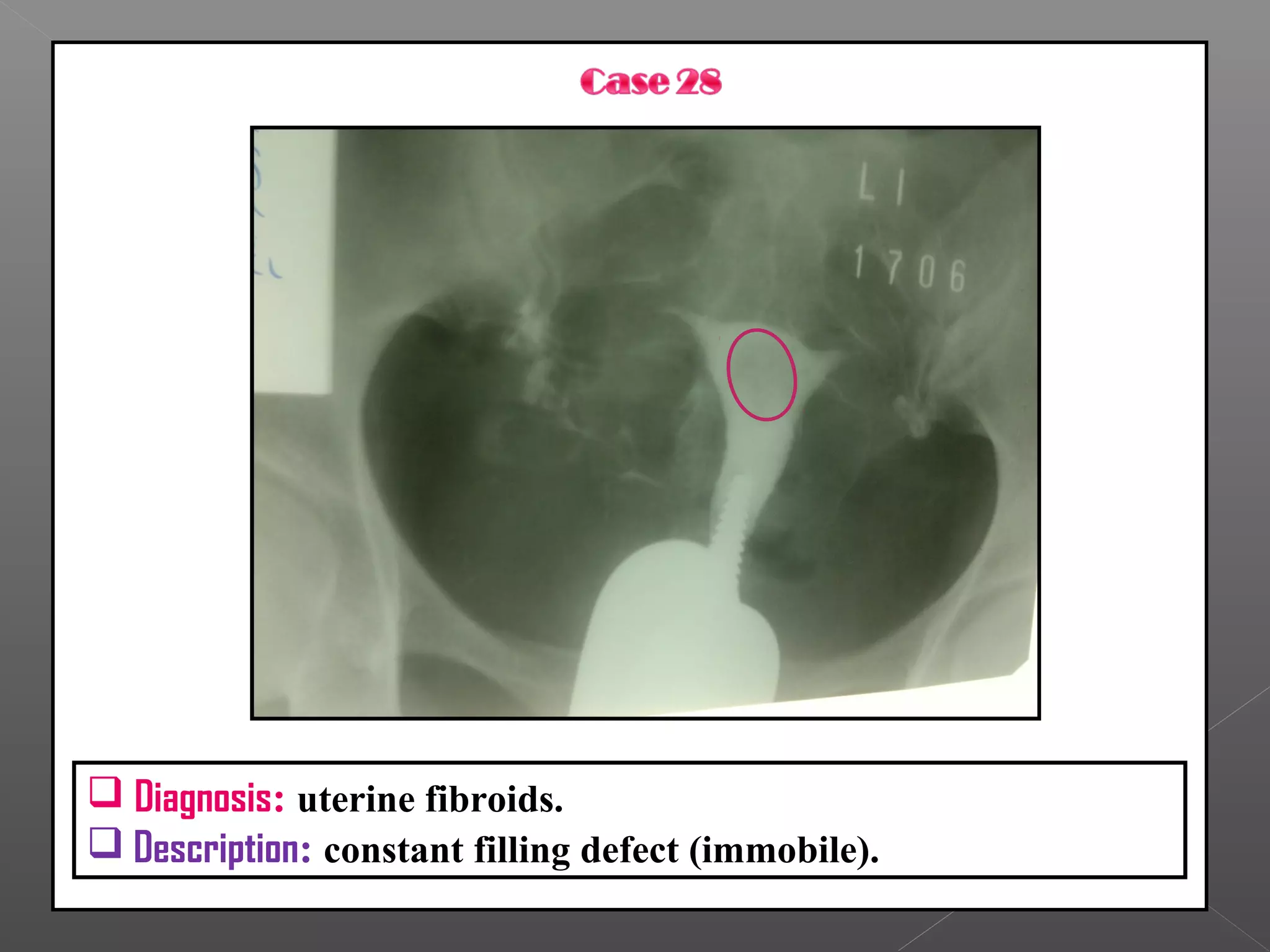 Hysterosalpingography | PPT