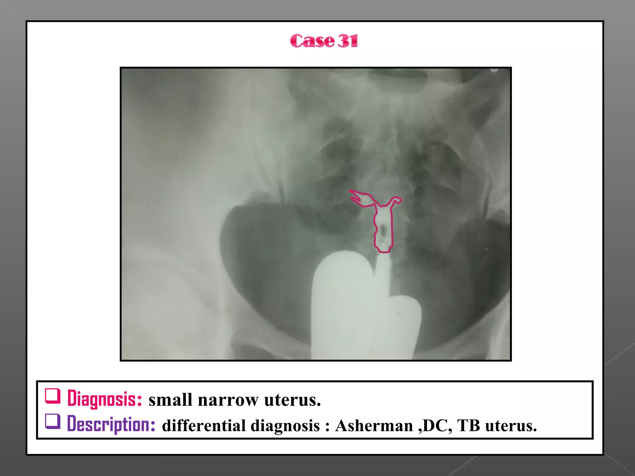 Hysterosalpingography | PPT