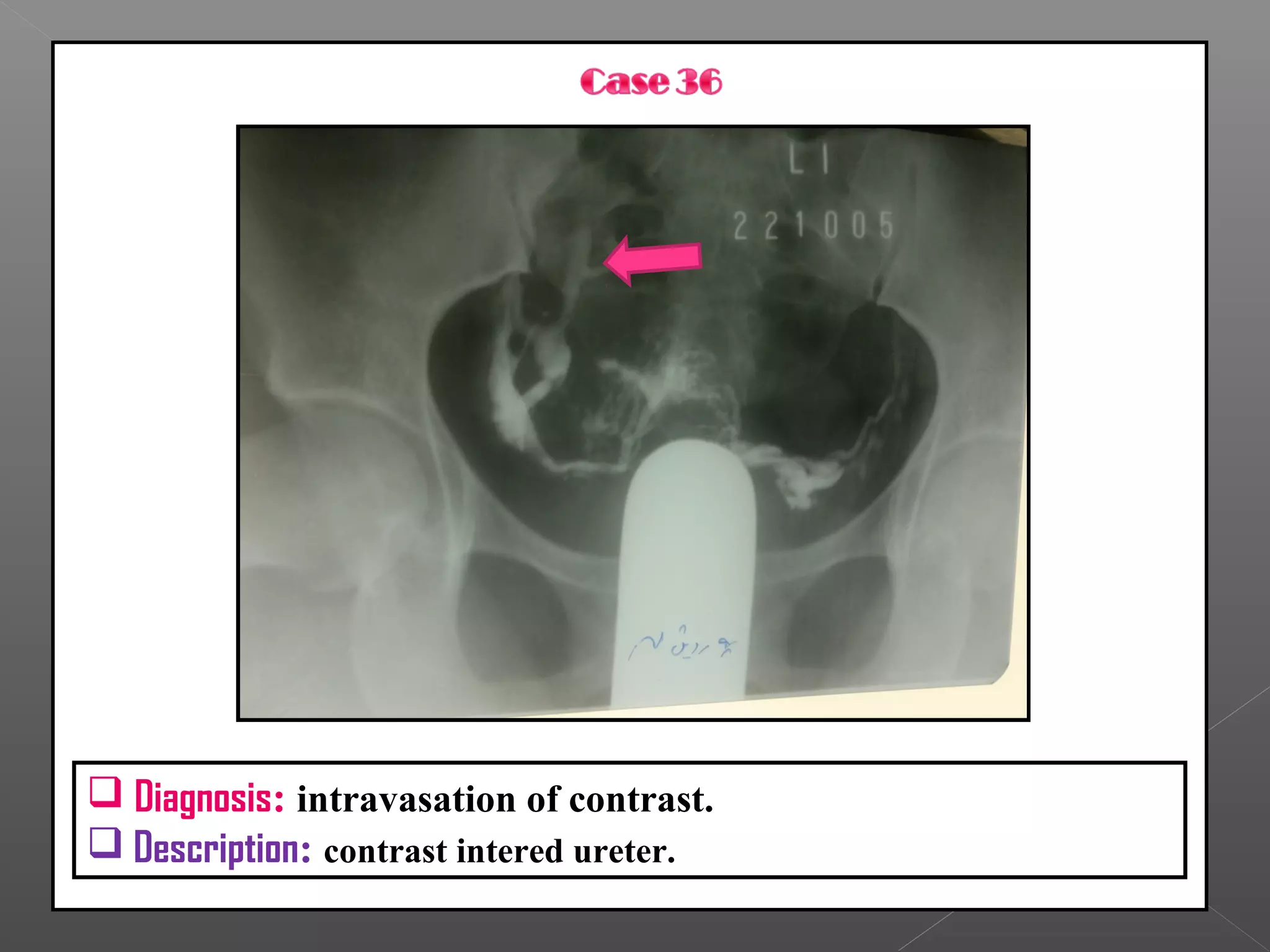Hysterosalpingography | PPT