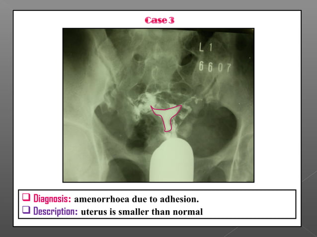 Hysterosalpingography | PPT