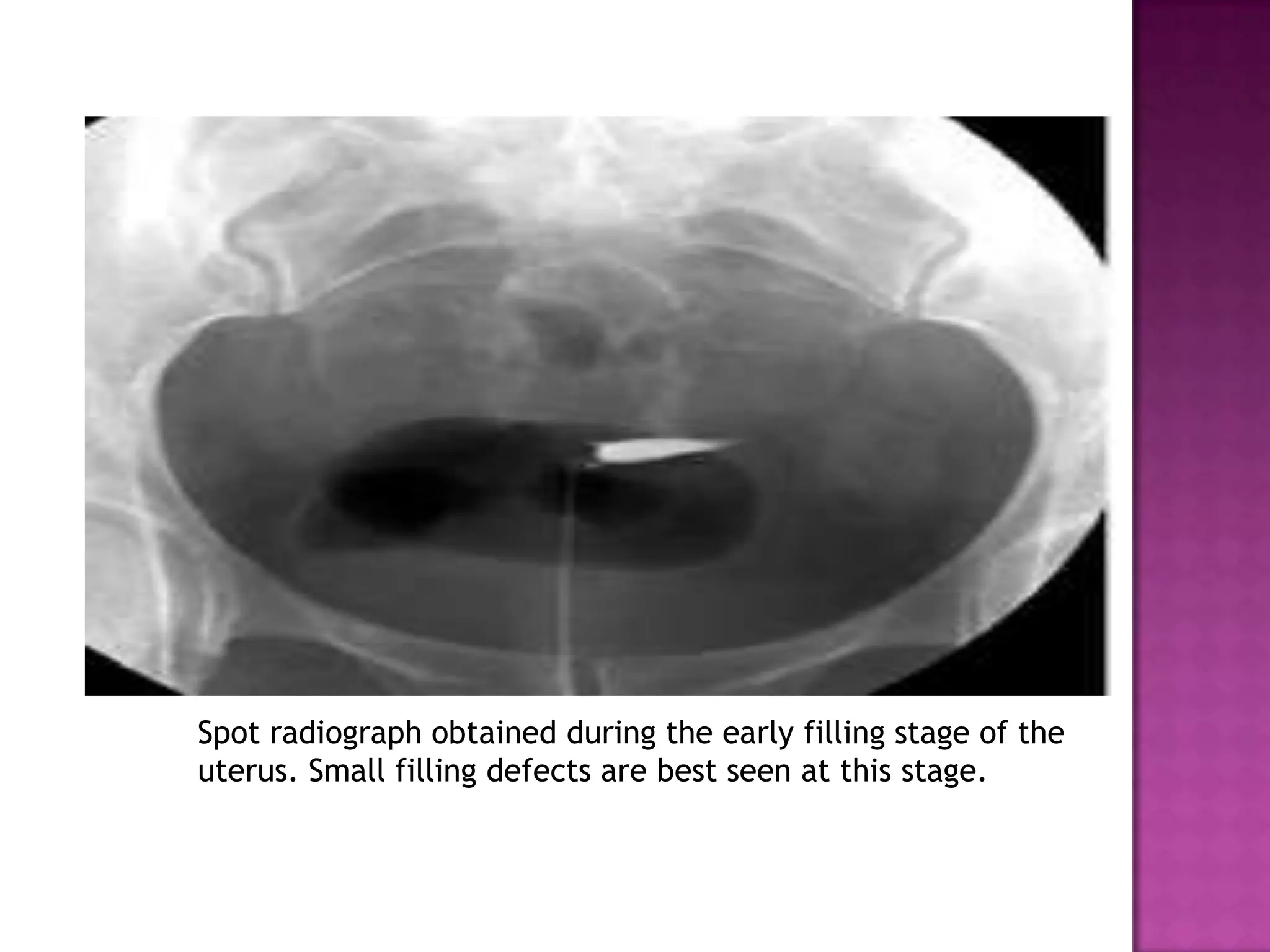 Hysterosalpingography | PPTX
