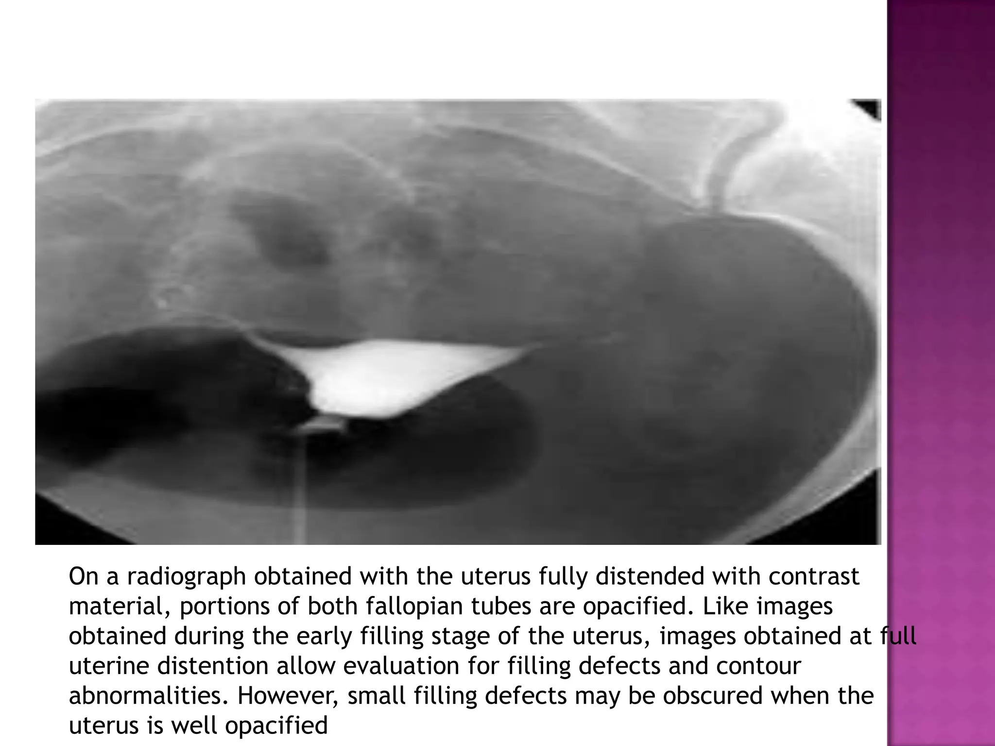 Hysterosalpingography | PPTX