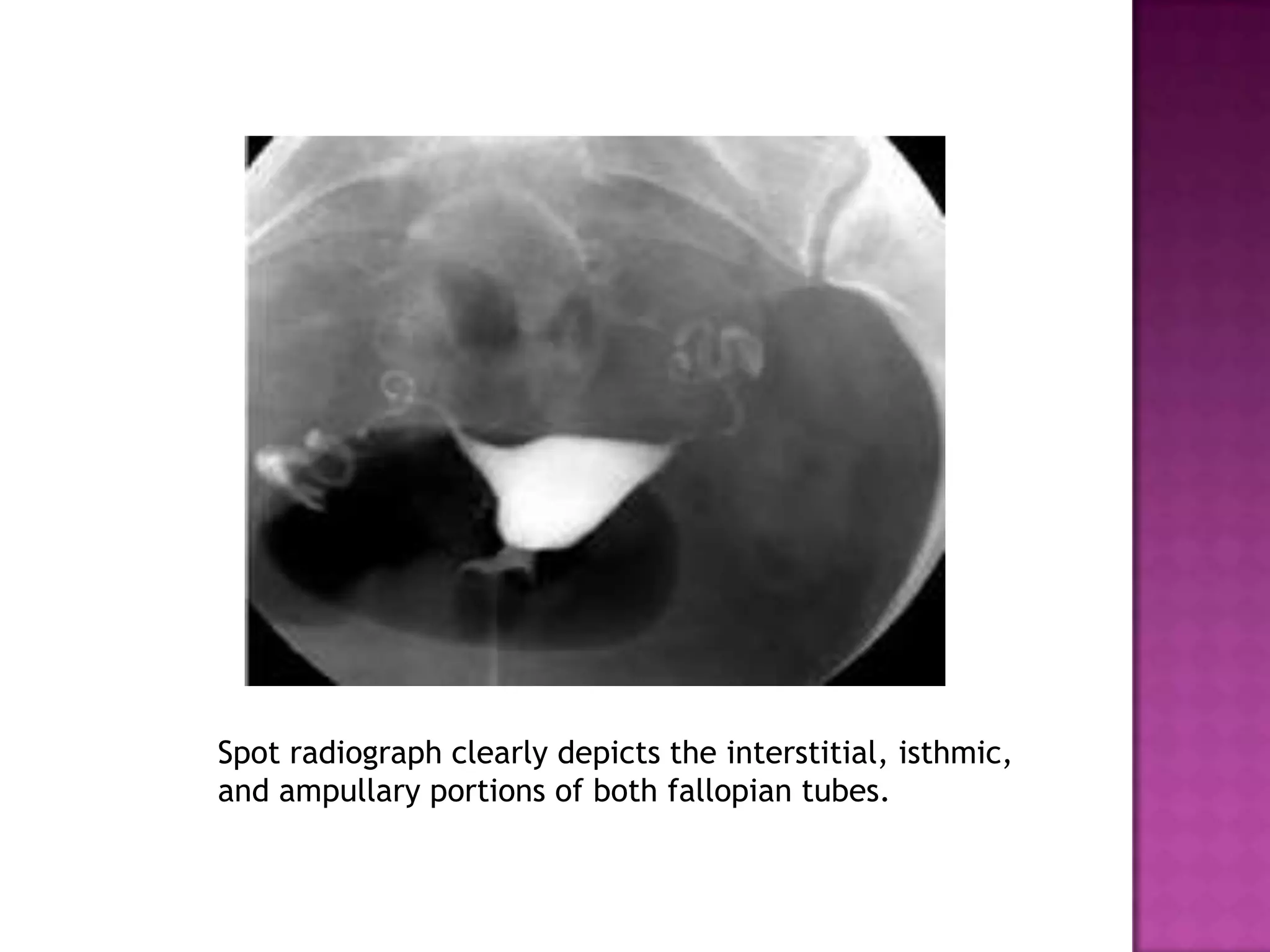 Hysterosalpingography | PPTX
