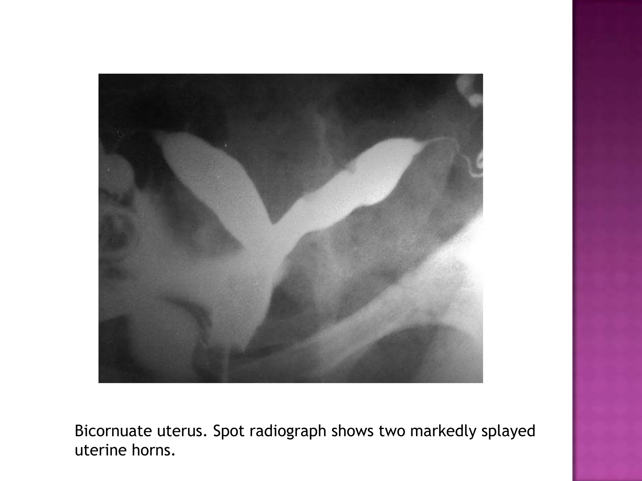 Hysterosalpingography | PPTX