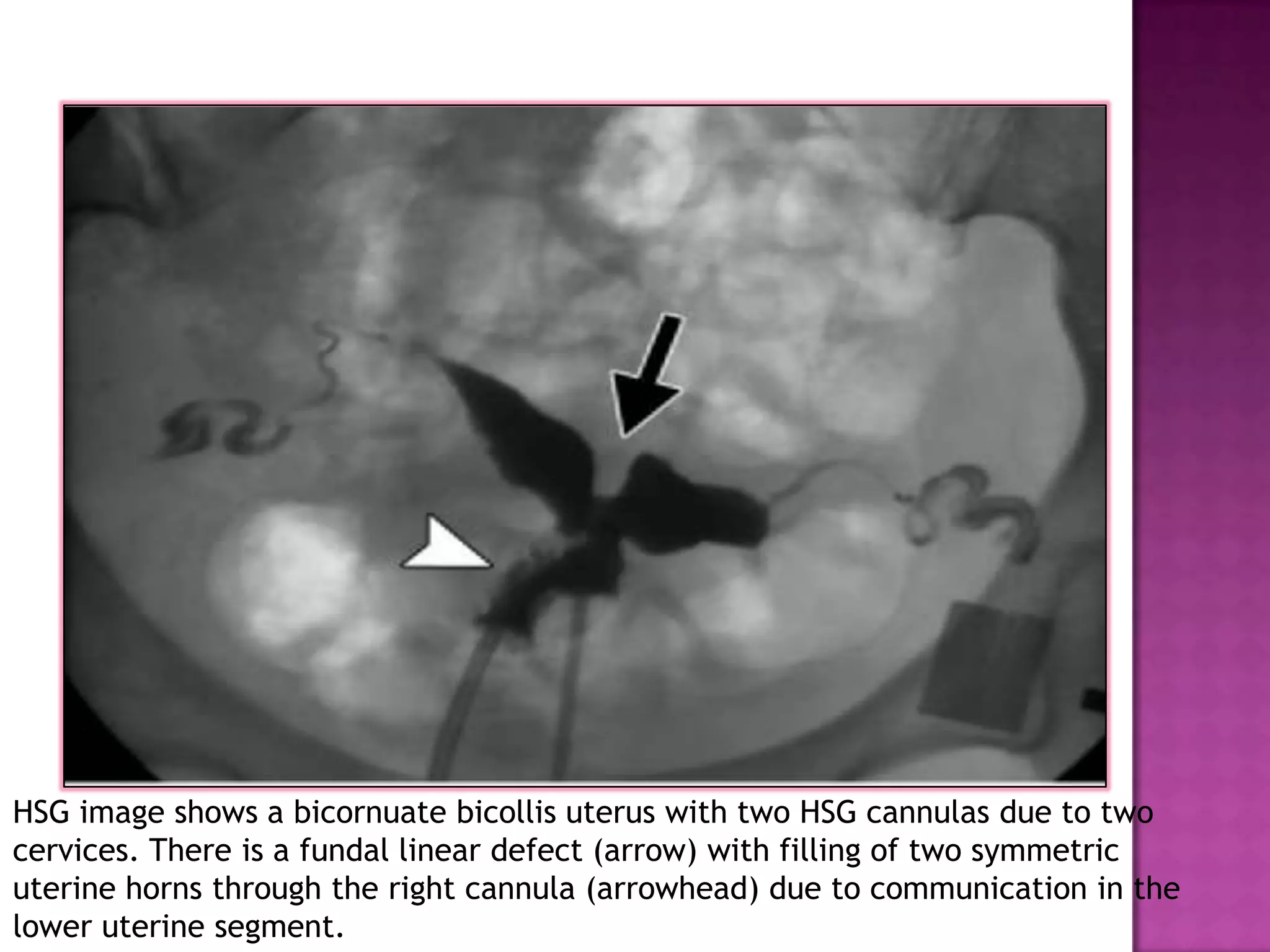 Hysterosalpingography | PPTX