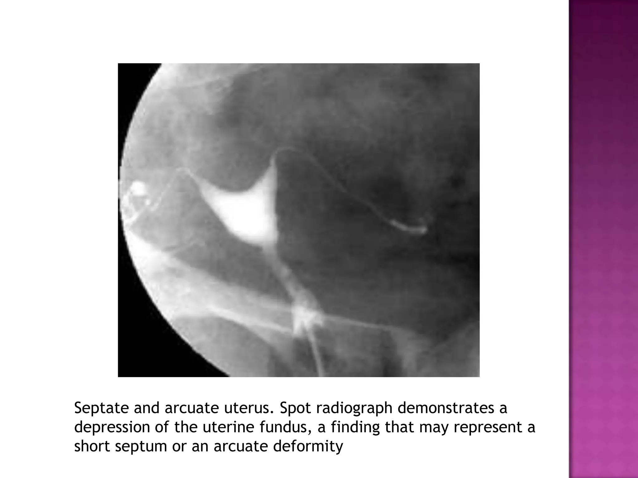 Hysterosalpingography | PPTX