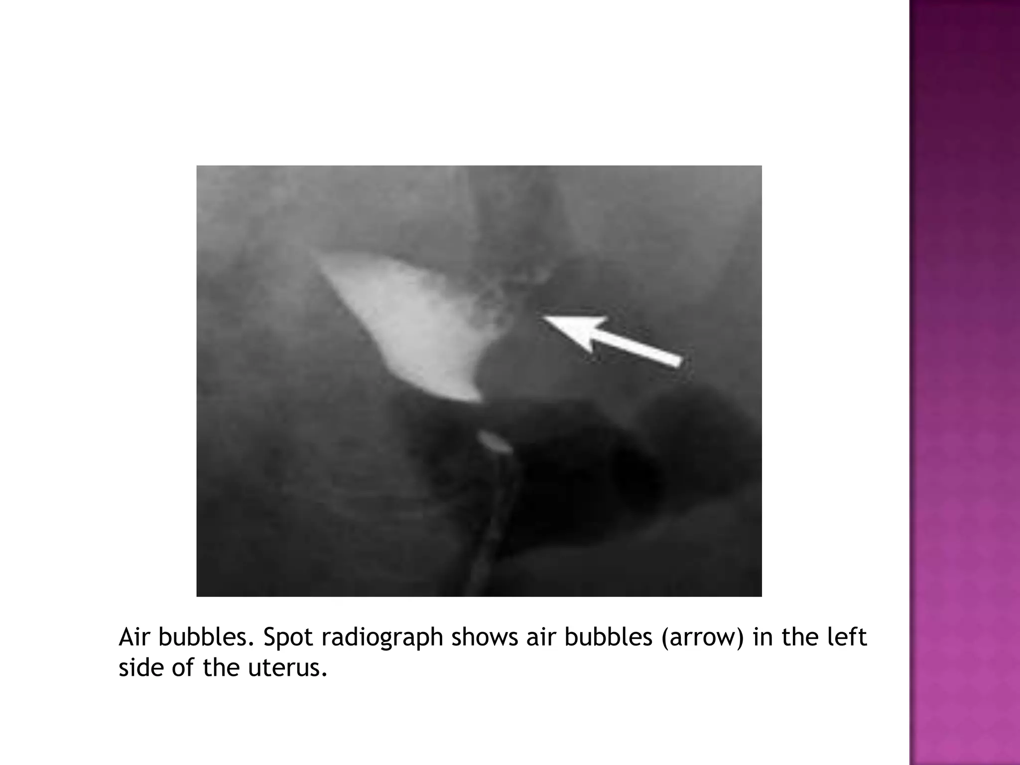 Hysterosalpingography | PPTX